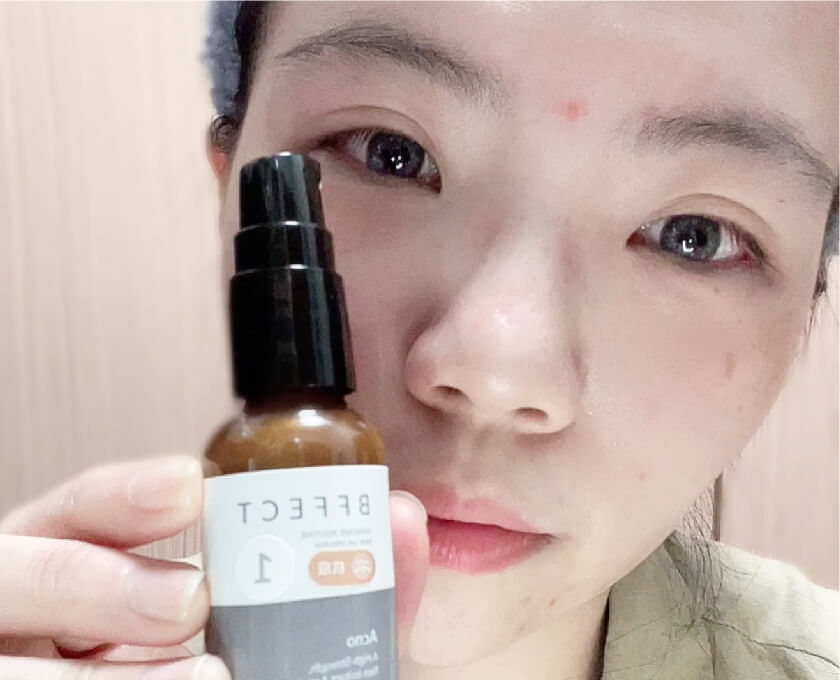 毛孔張開的感覺，痘痘和暗沉都明顯改善了！也不容易長痘了-孟欣 – BFFECT USA